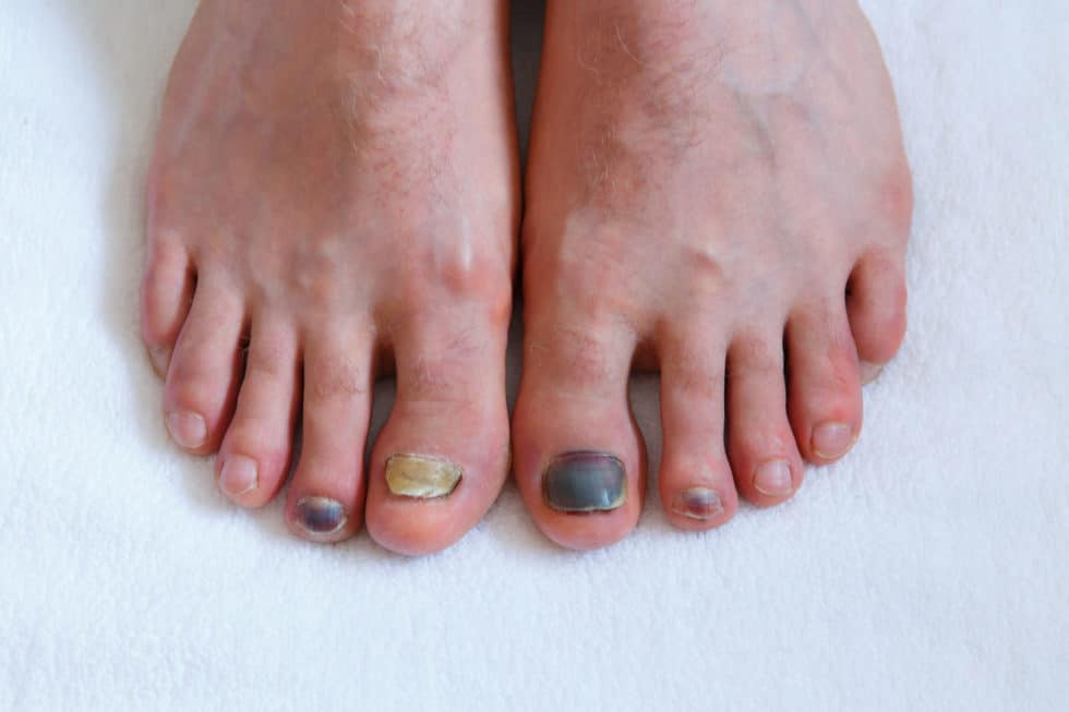 Black Toenails | Family Foot Care & Surgery, LLC | Serving Those in ...
