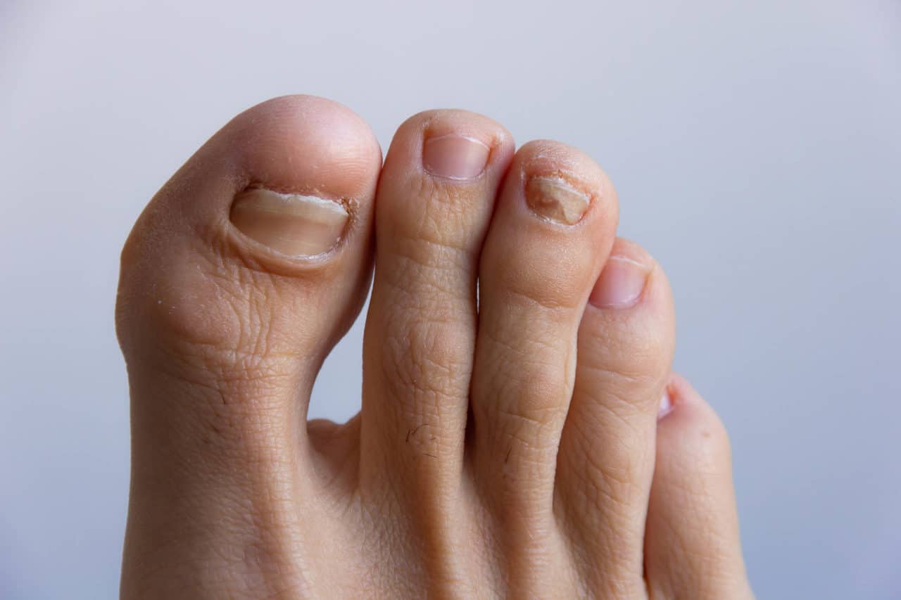Hammertoe Treatment Hamden, CT | Family Foot Care & Surgery