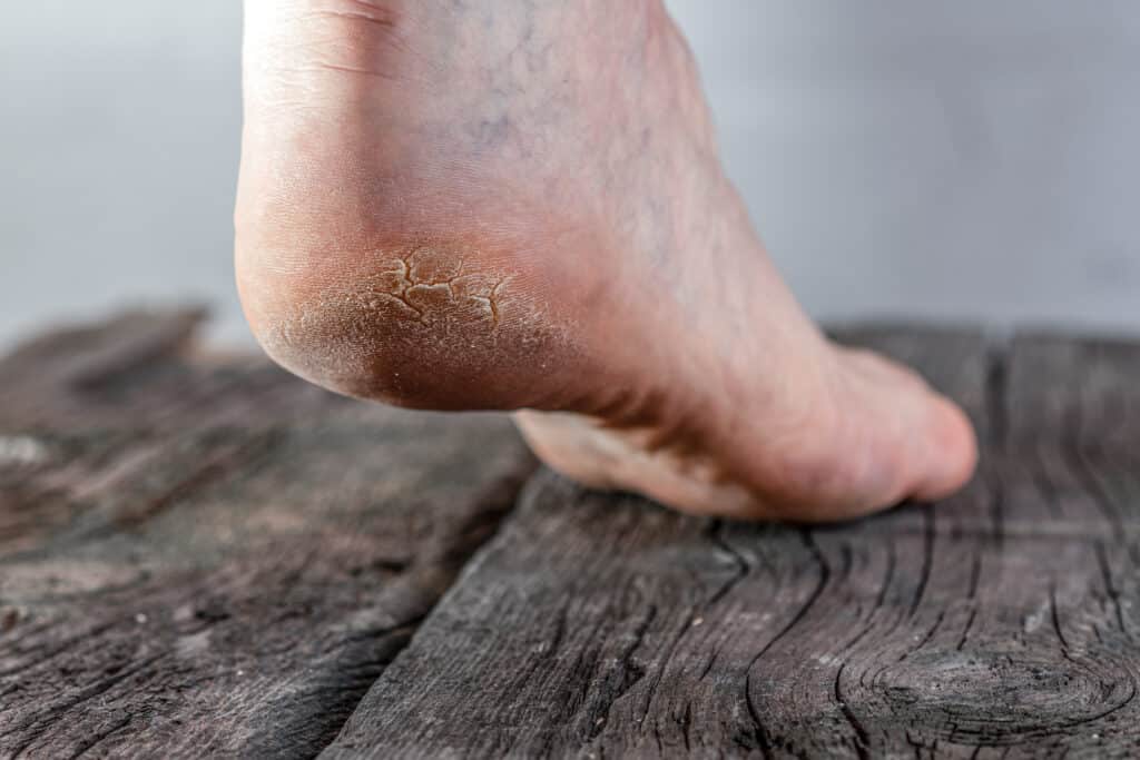 Heel Fissures | Heel Pain | Family Foot Care & Surgery, LLC | Serving ...